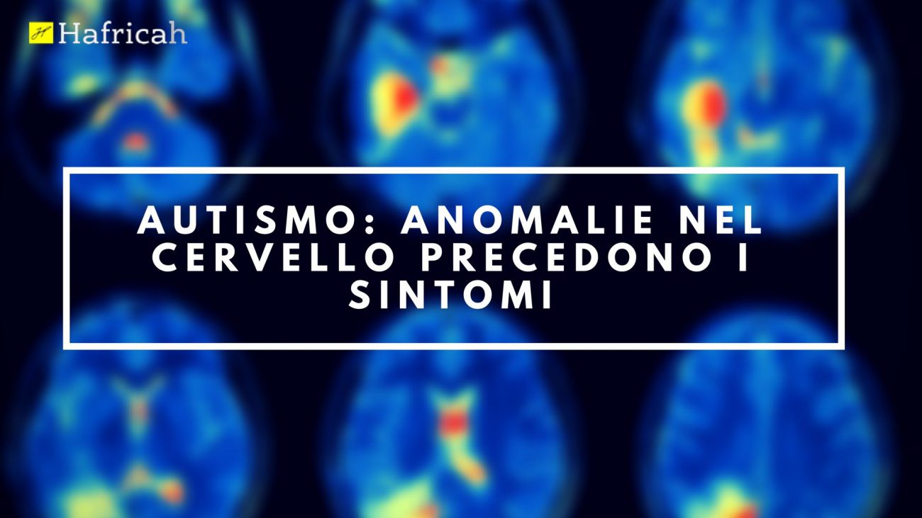 Autismo. Le alterazioni nel cervello sono visibili a 6 mesi ~ Hafricah.NET